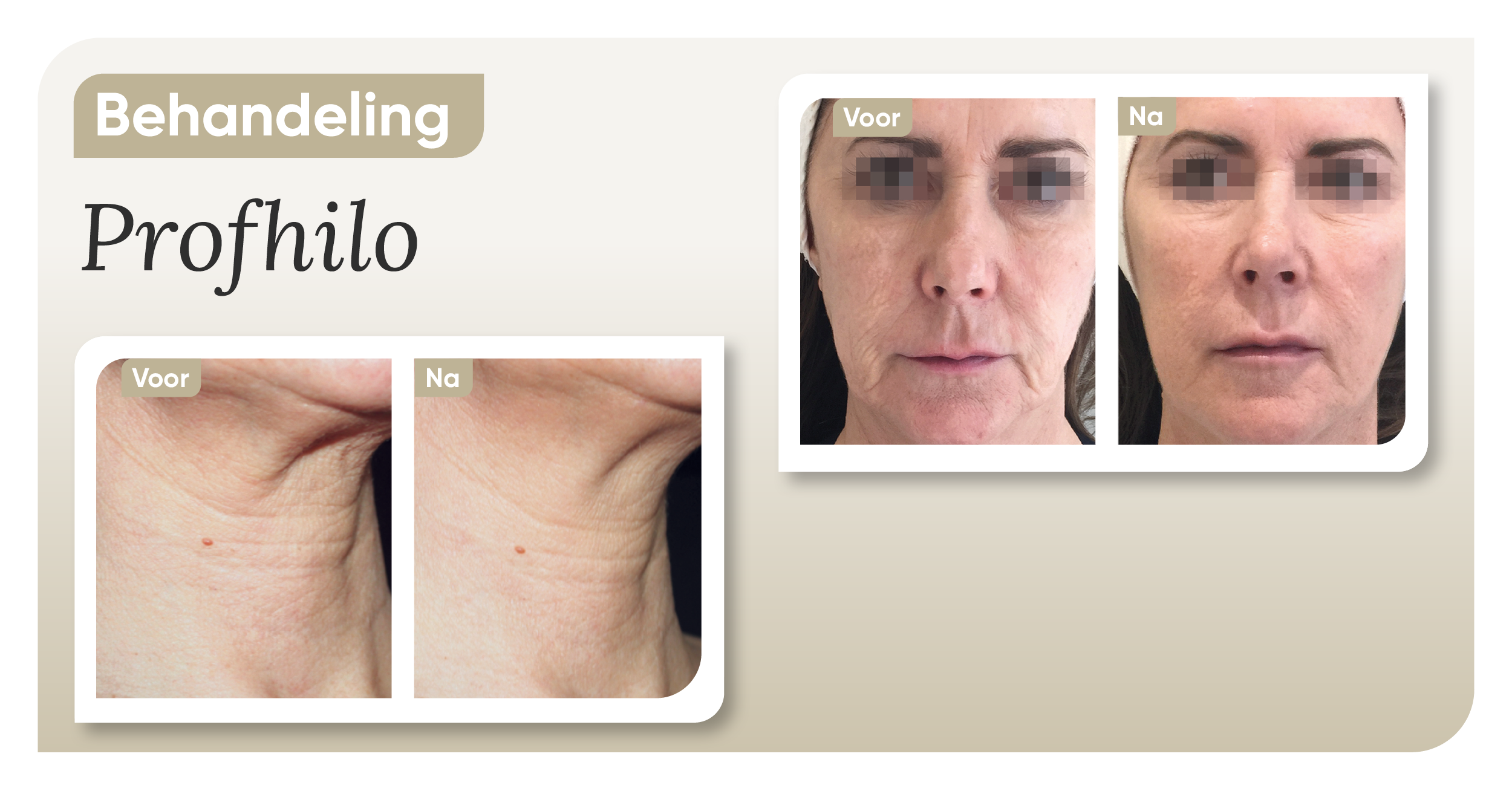 Profhilo: bewezen effectieve skinbooster